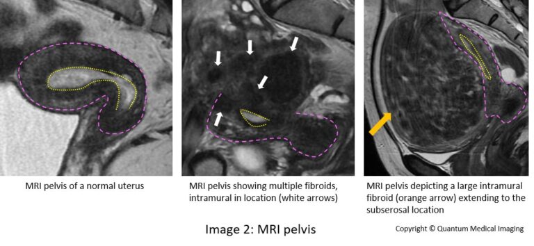 Uterine Fibroids Quantum Medical Imaging